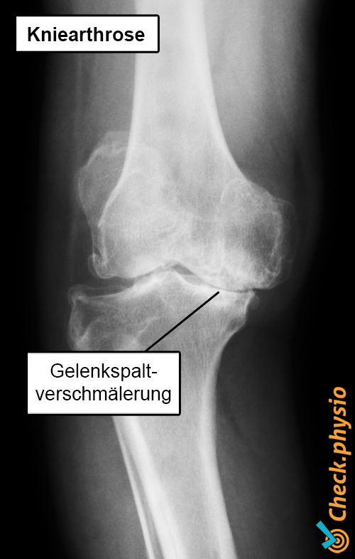 Ursache, Symptome & Behandlung | Kniearthrose - Physiotest.de