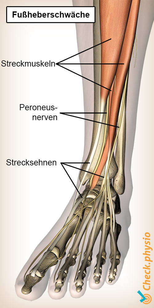 Ursache, Symptome & Behandlung | Fallfuß - Physiotest.de