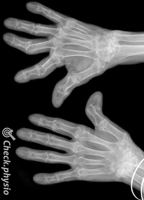 Rheuma (Rheumatoide Arthritis) | Ursache, Symptome & Behandlung