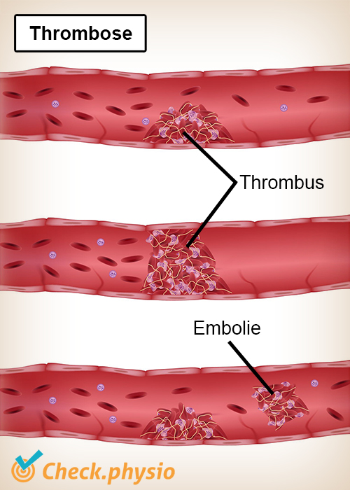 Ursache, Symptome & Behandlung | Beinthrombose - Physiotest.de
