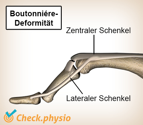 Boutonnière-Deformität | Ursache, Symptome & Behandlung