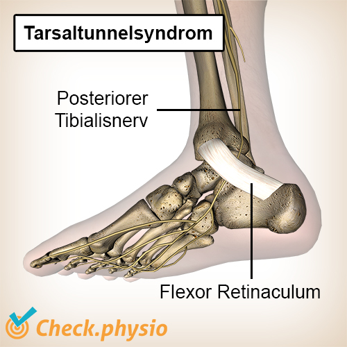 Tarsaltunnelsyndrom | Ursache, Symptome & Behandlung