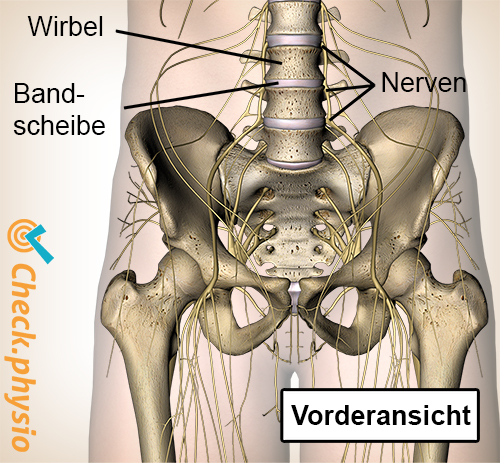 Lumbosakrales Radikuläres Syndrom (Bandscheibenvorfall)